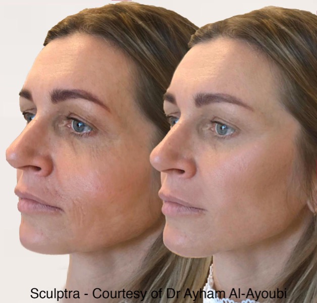 Sculptra ® (Formerly New-Fill) Tissue Stimulator Information