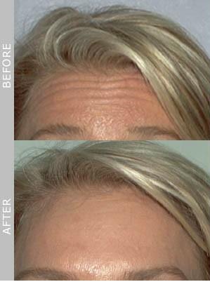 Bespoke Botox Treatments for You | Elixir Treatments, Egham