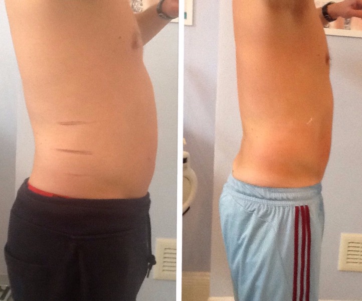 Cryolipolysis (CoolSculpting) Information