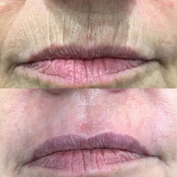 Fractional Laser Skin Resurfacing Information