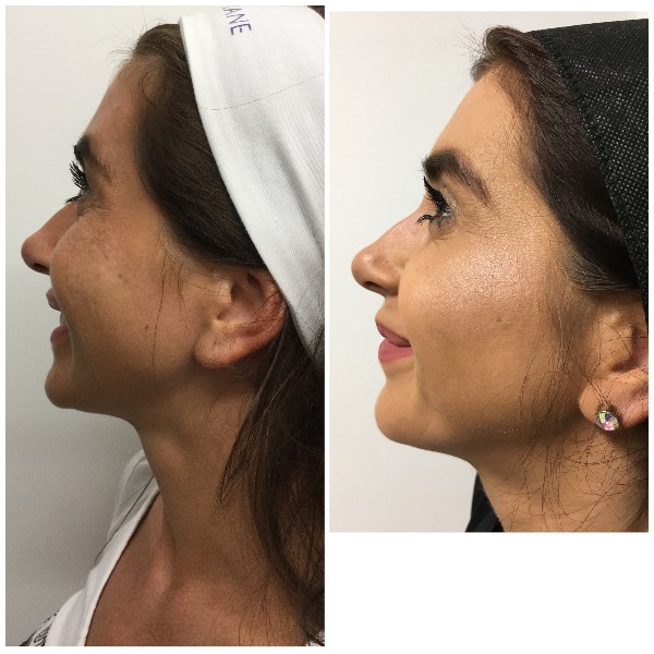 Sunken Cheeks Treatment Options