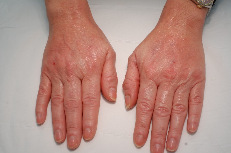 Ellanse Dermal Filler