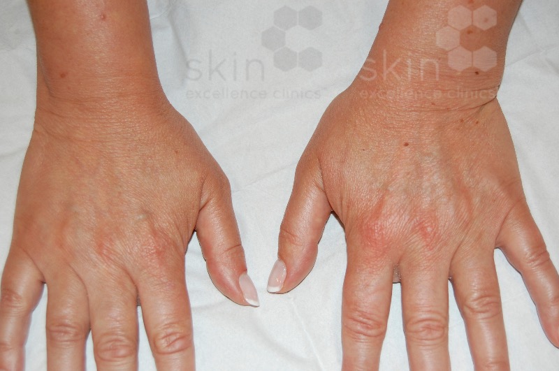 Ellanse Dermal Filler