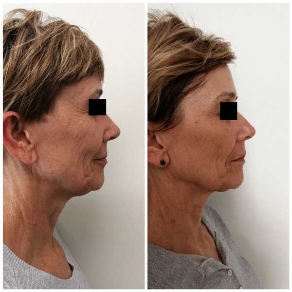 Radiofrequency For Facial Rejuvenation Information