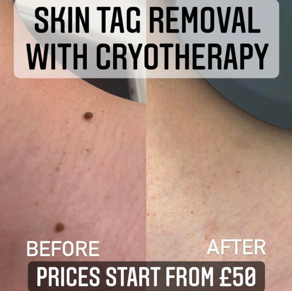 Moles, Warts, Skin Tags and Benign Growth Treatment Options