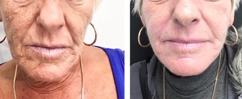 Ellanse Dermal Filler