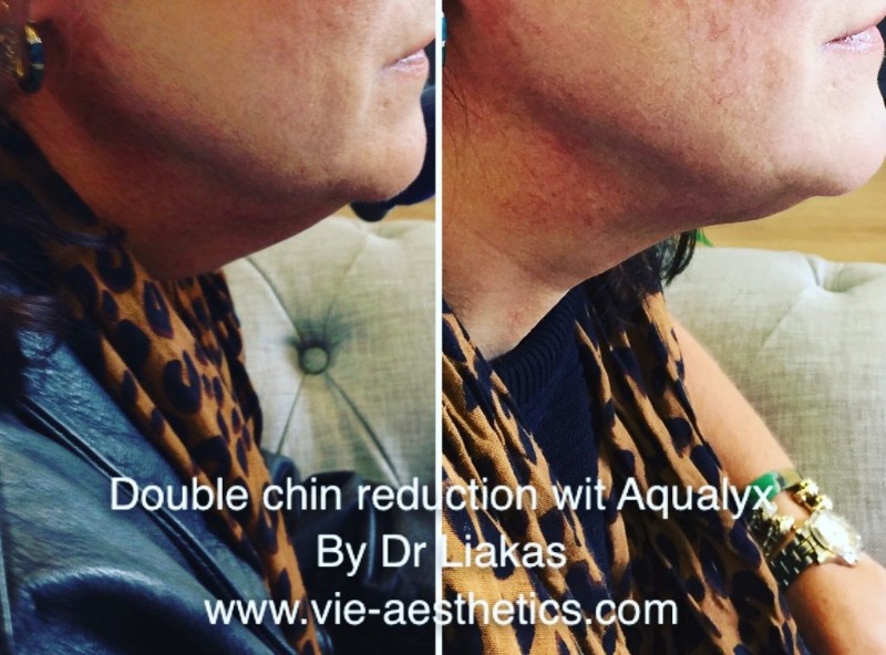 AQUALYX ™ Fat Dissolving Injections Information