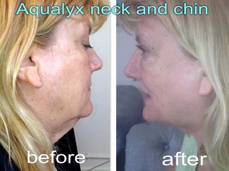 AQUALYX ™ Fat Dissolving Injections Information