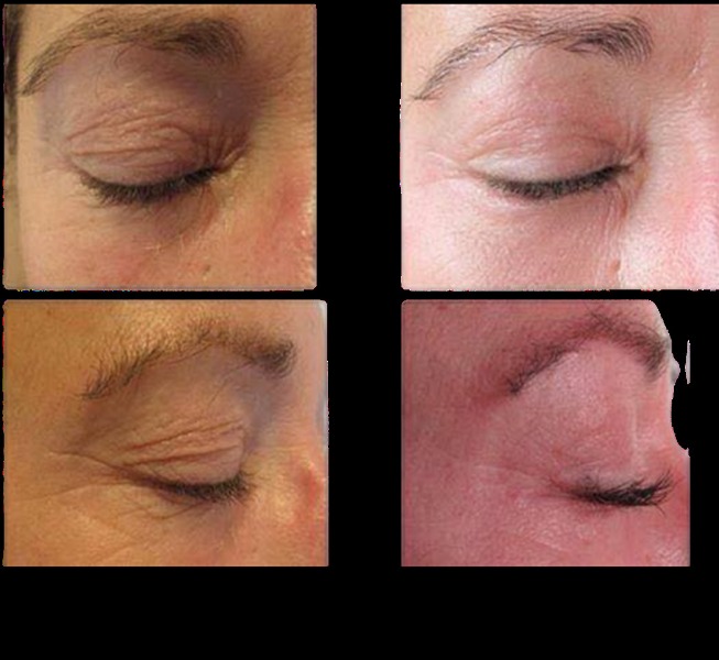 Plasma Skin Resurfacing (PSR) - NeoGen / Portrait Plasma Skin Regeneration