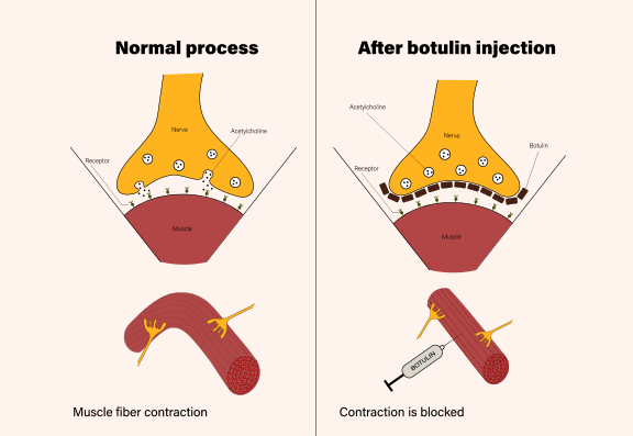 What is Botox and how does it work? | ConsultingRoom