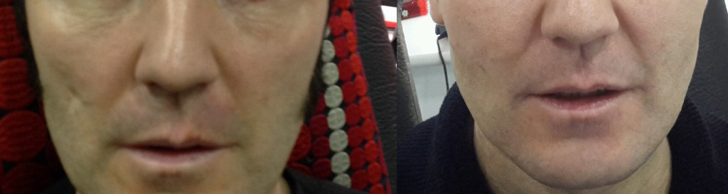 Dermal Fillers for Facial Scars