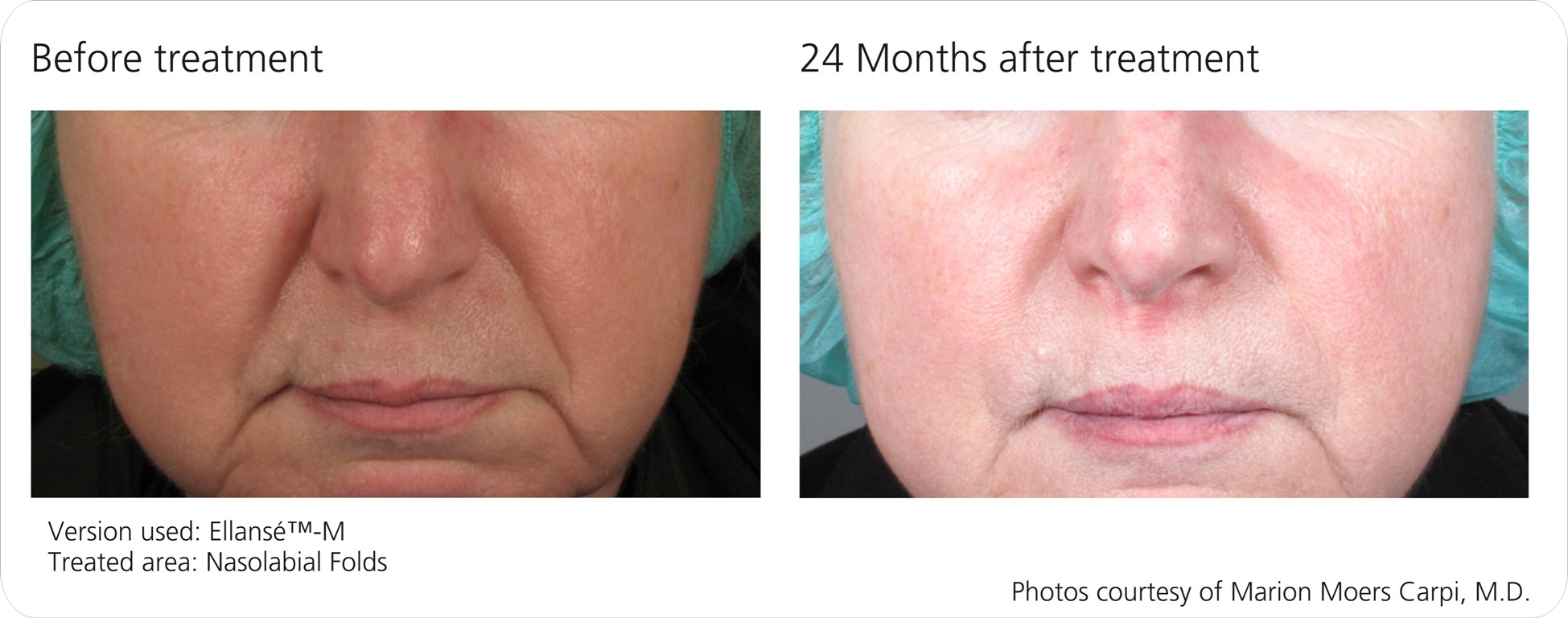 Ellanse Dermal Filler