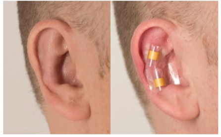 earFold ™ Ear Correction Surgery (Otoplasty) Information